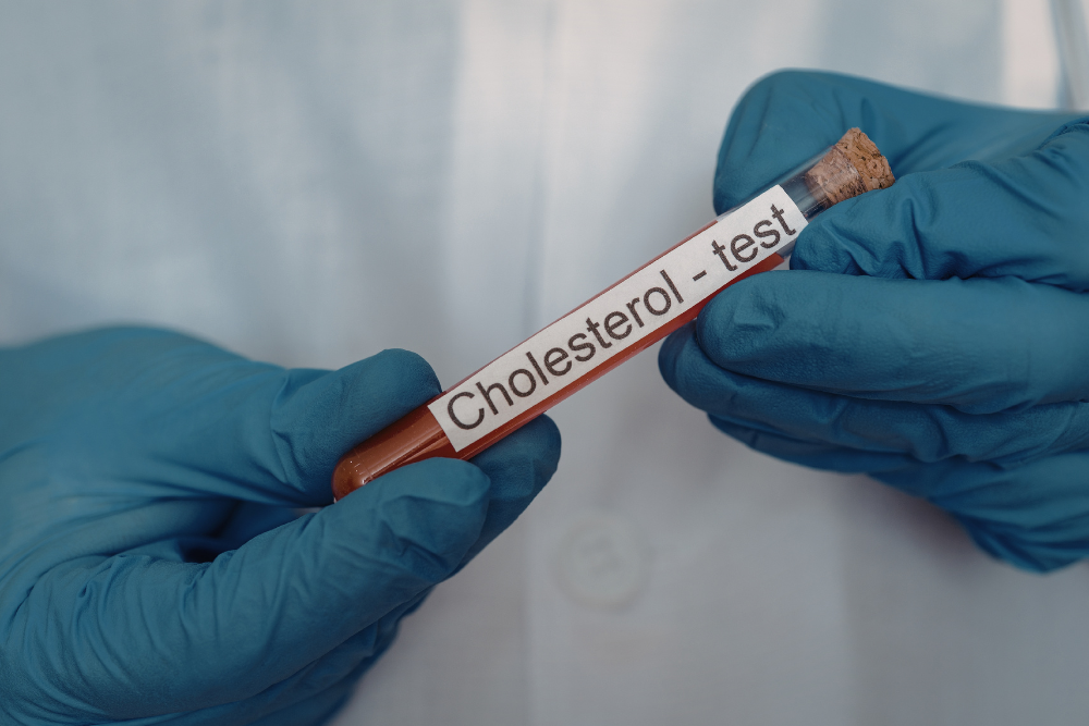 Lipid Profile Test Report: Understand Your Cholesterol Levels